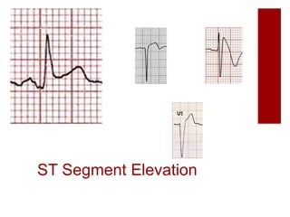 ECG interpretation | PPTX