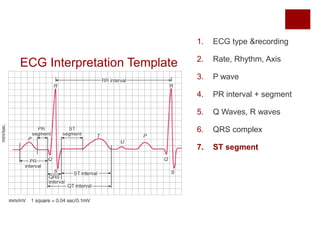 Ecg Interpretation