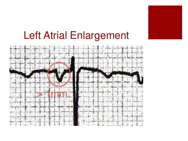 ECG interpretation