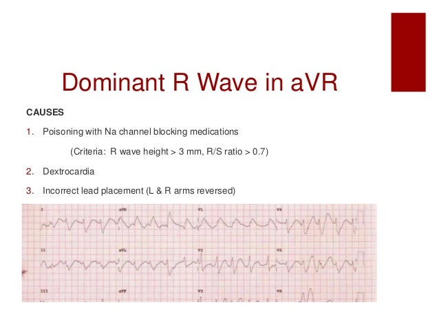 ECG interpretation