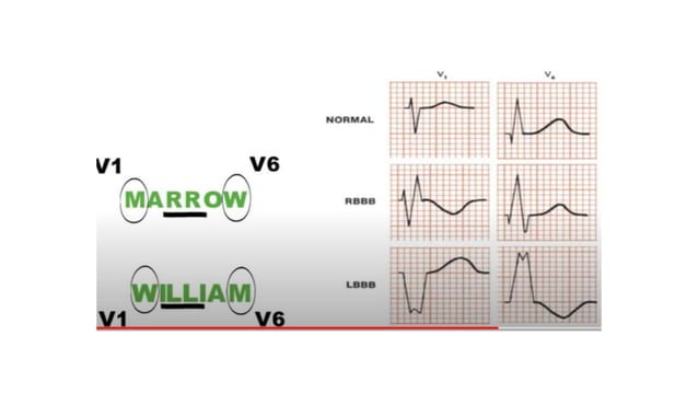 Ecg interpretation | PPT