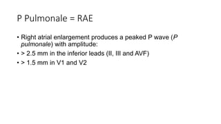 Ecg interpretation , Upgraded | PPTX