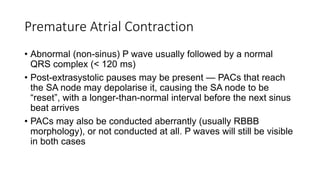 Ecg interpretation , Upgraded | PPTX
