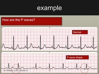 ECG Interpretation | PPTX