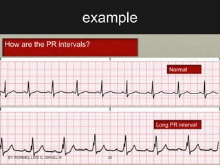 ECG Interpretation | PPTX