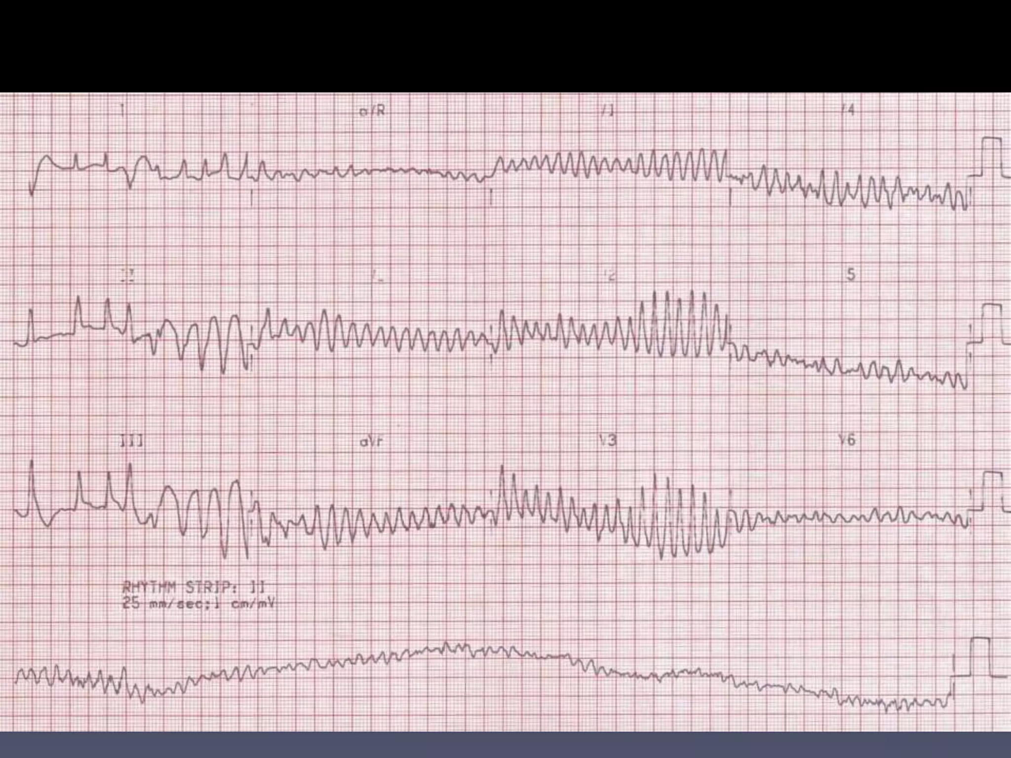 Systematic ECG Interpretation | PPTX