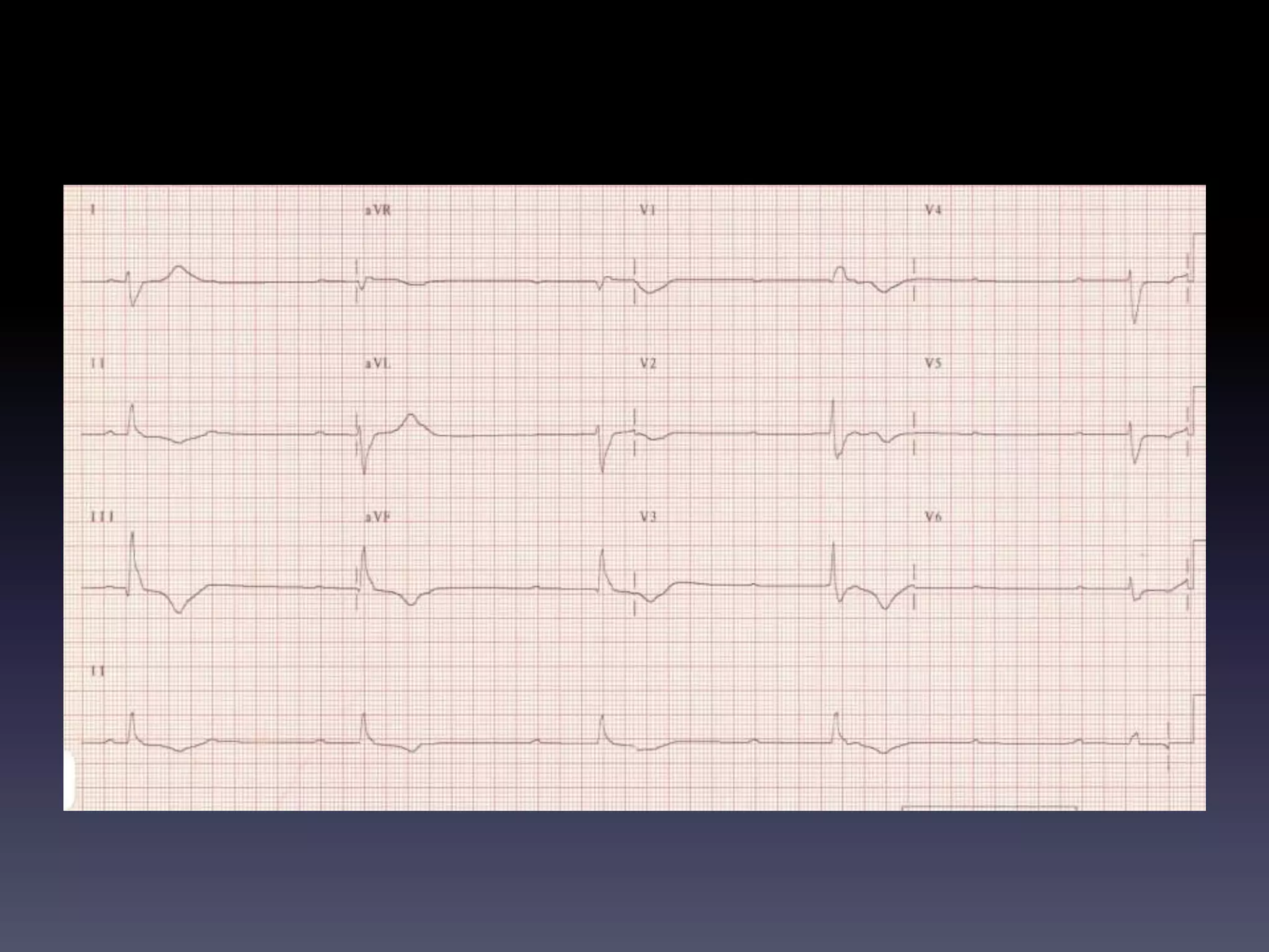 Systematic ECG Interpretation | PPTX
