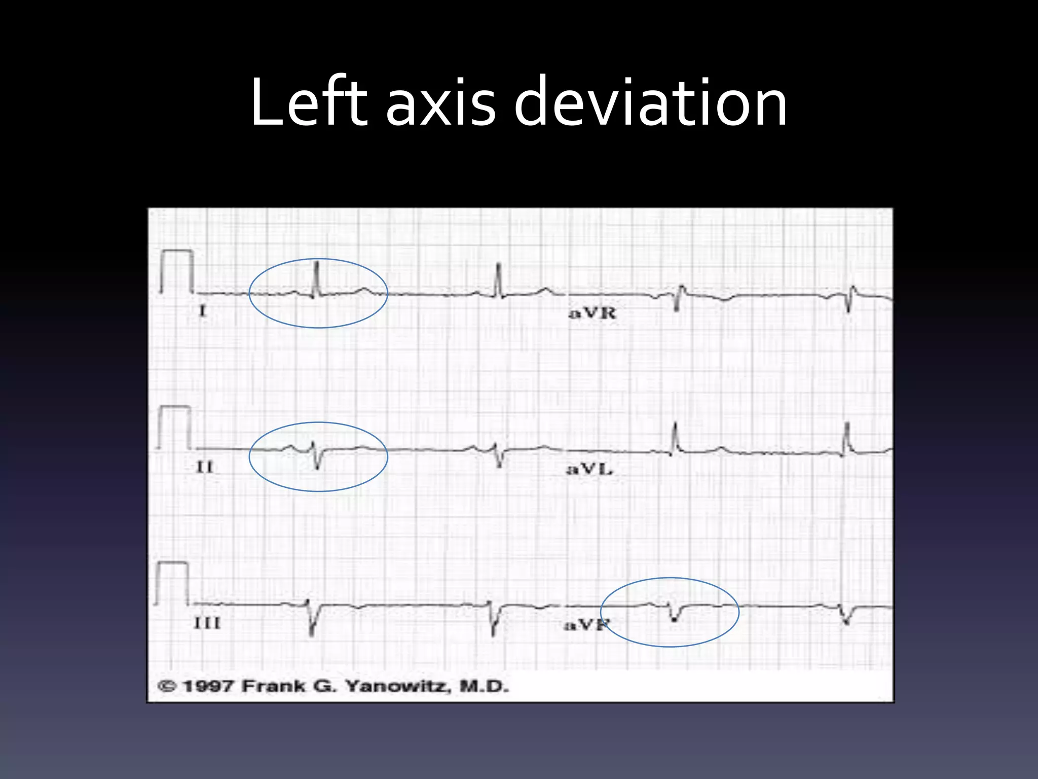 Systematic ECG Interpretation | PPTX | Heart and Cardiovascular ...