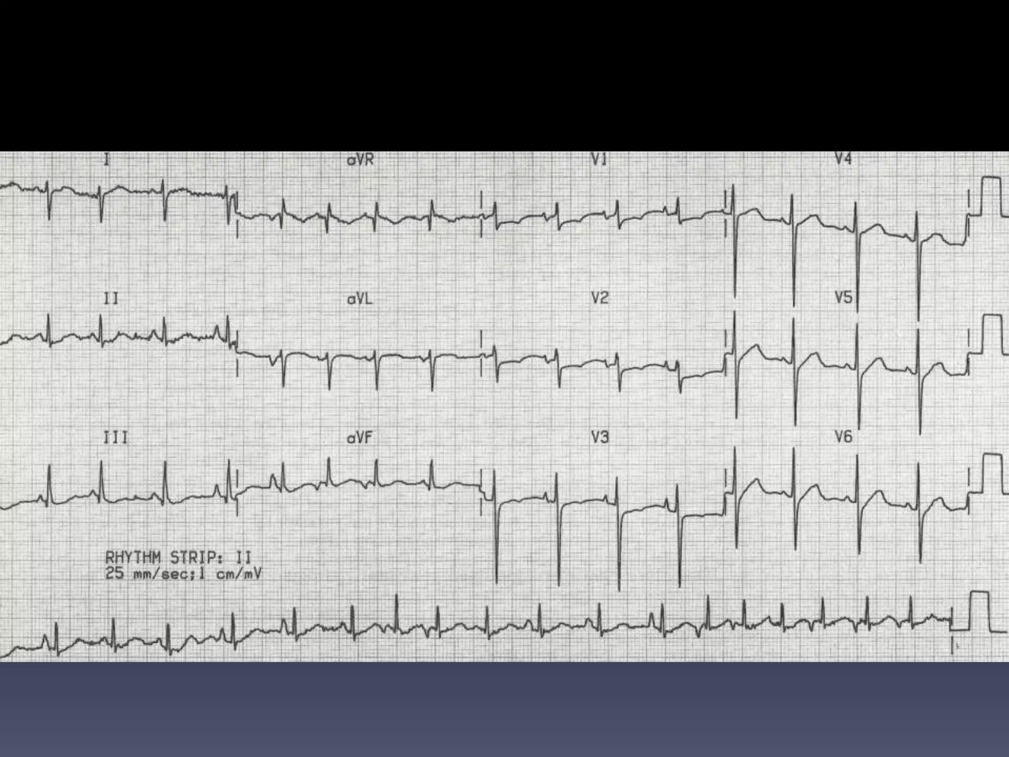 Systematic ECG Interpretation | PPTX