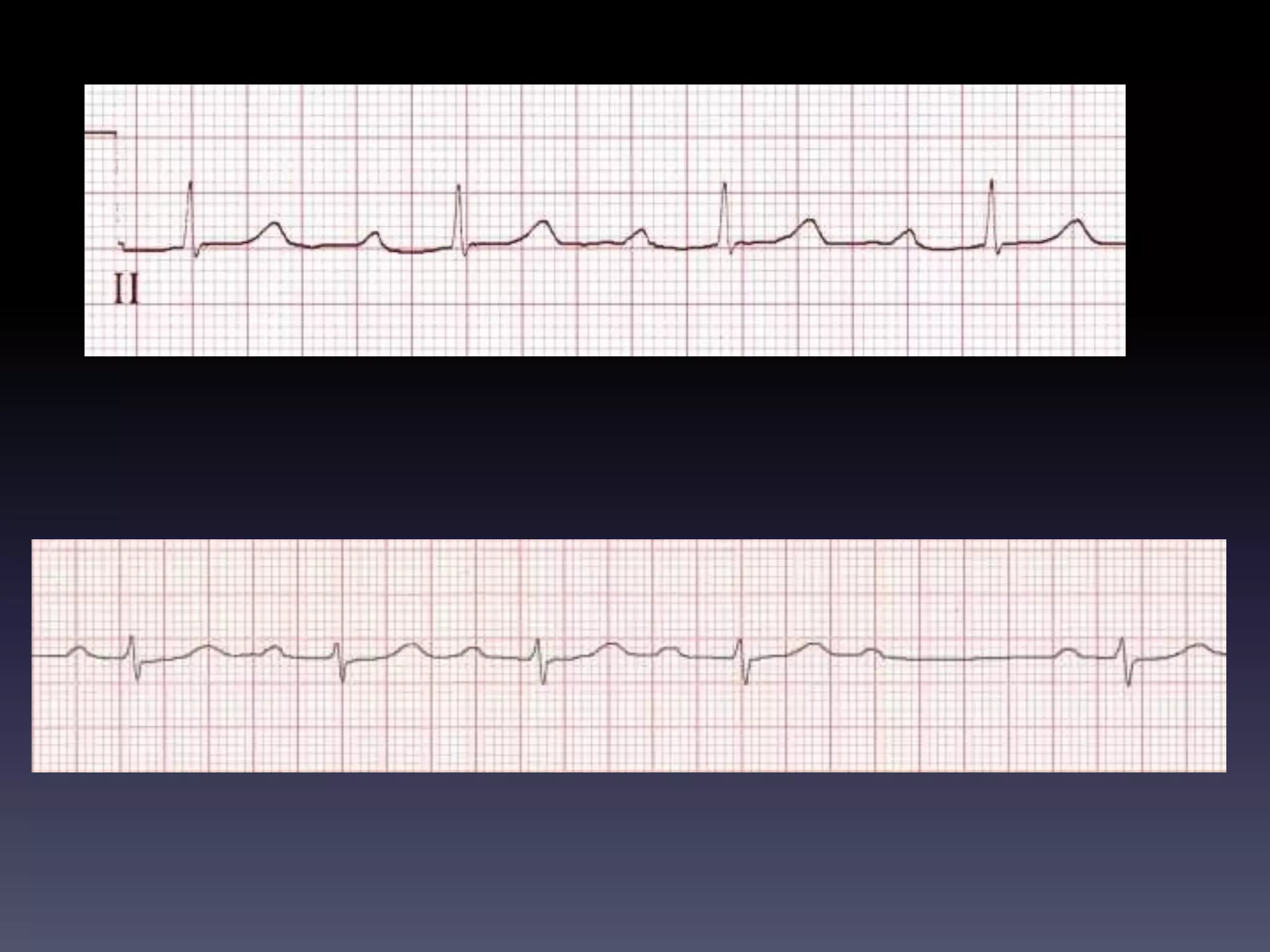 Systematic ECG Interpretation | PPTX