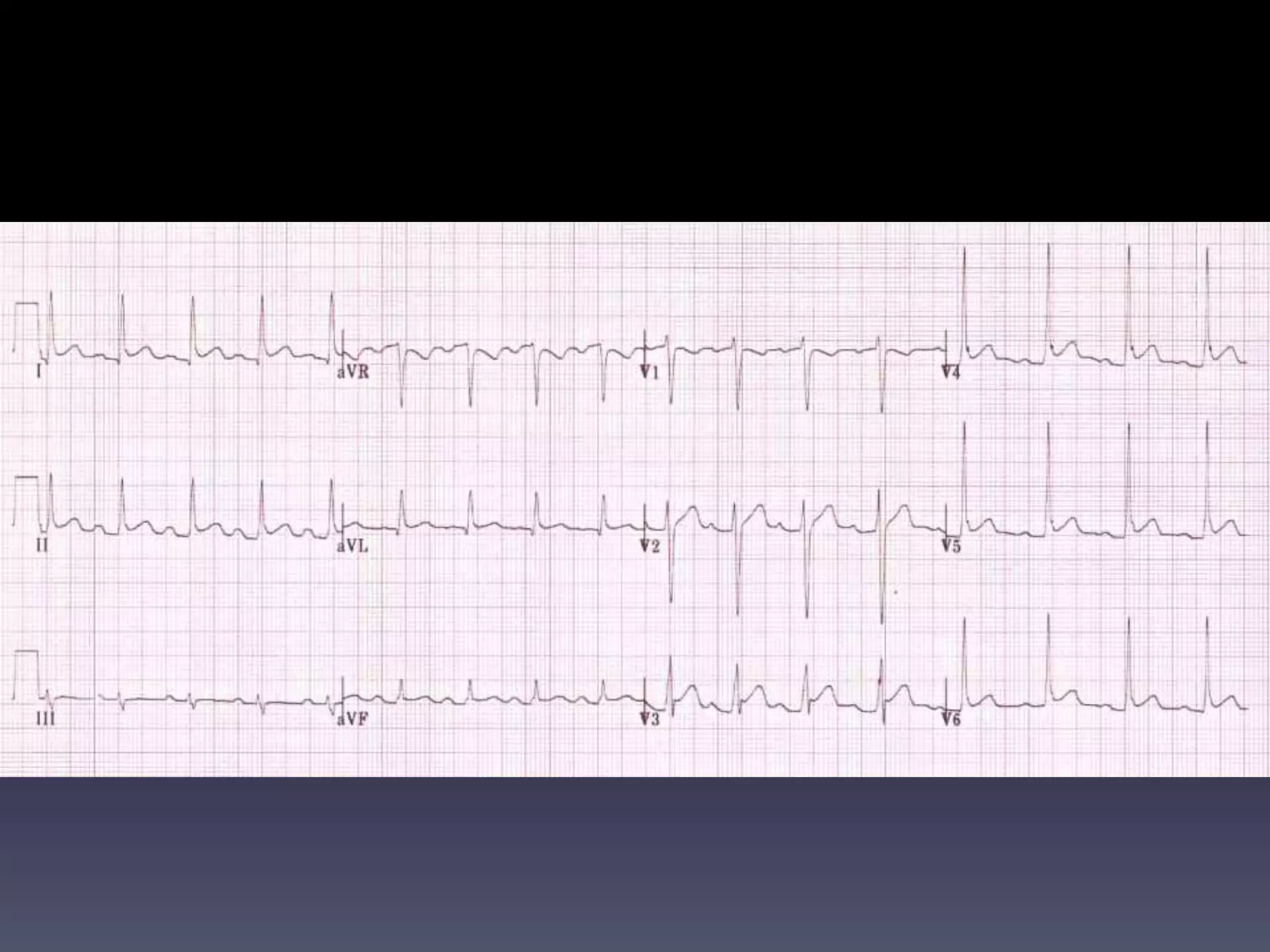 Systematic ECG Interpretation | PPTX