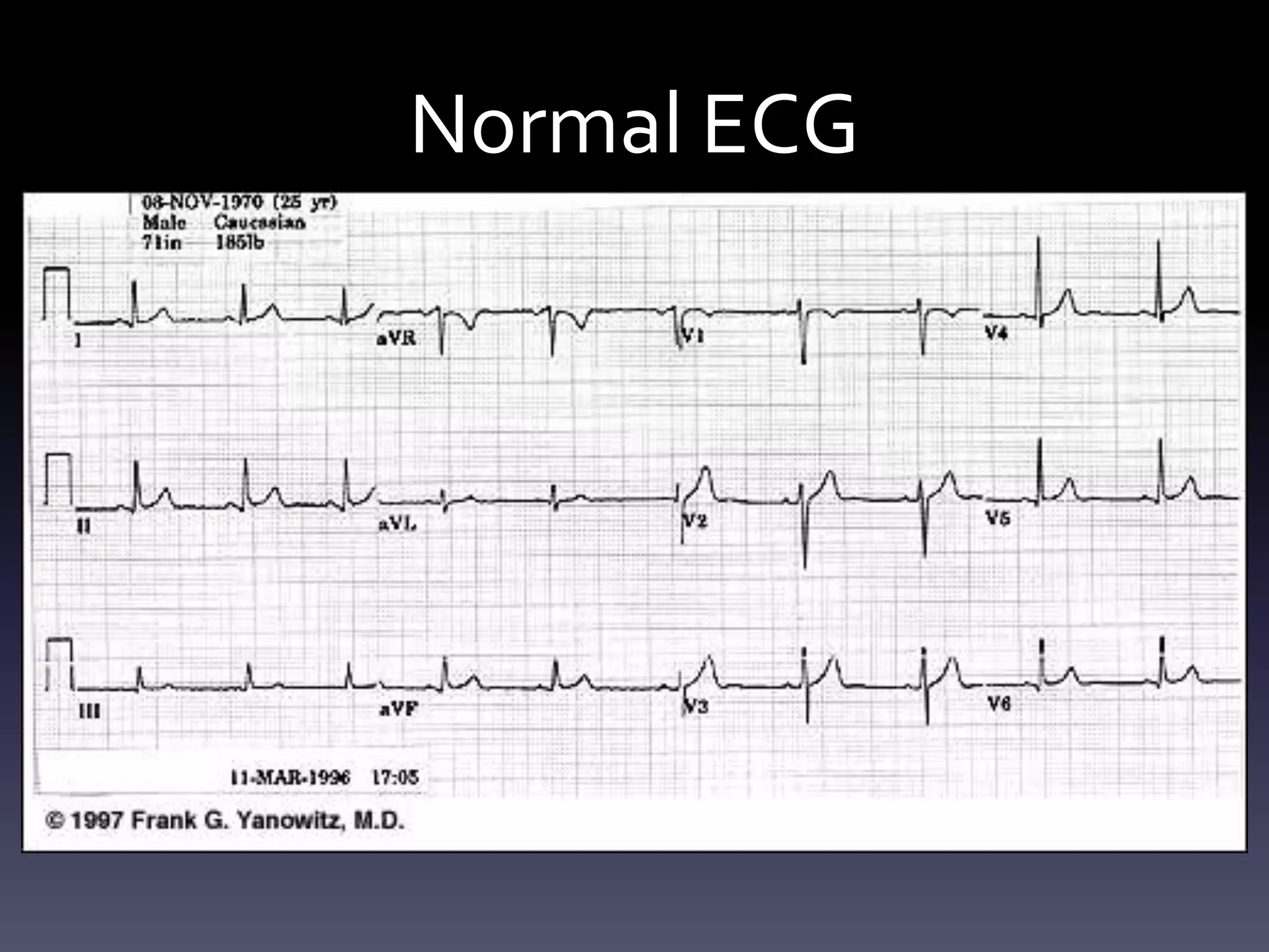 Systematic ECG Interpretation | PPTX
