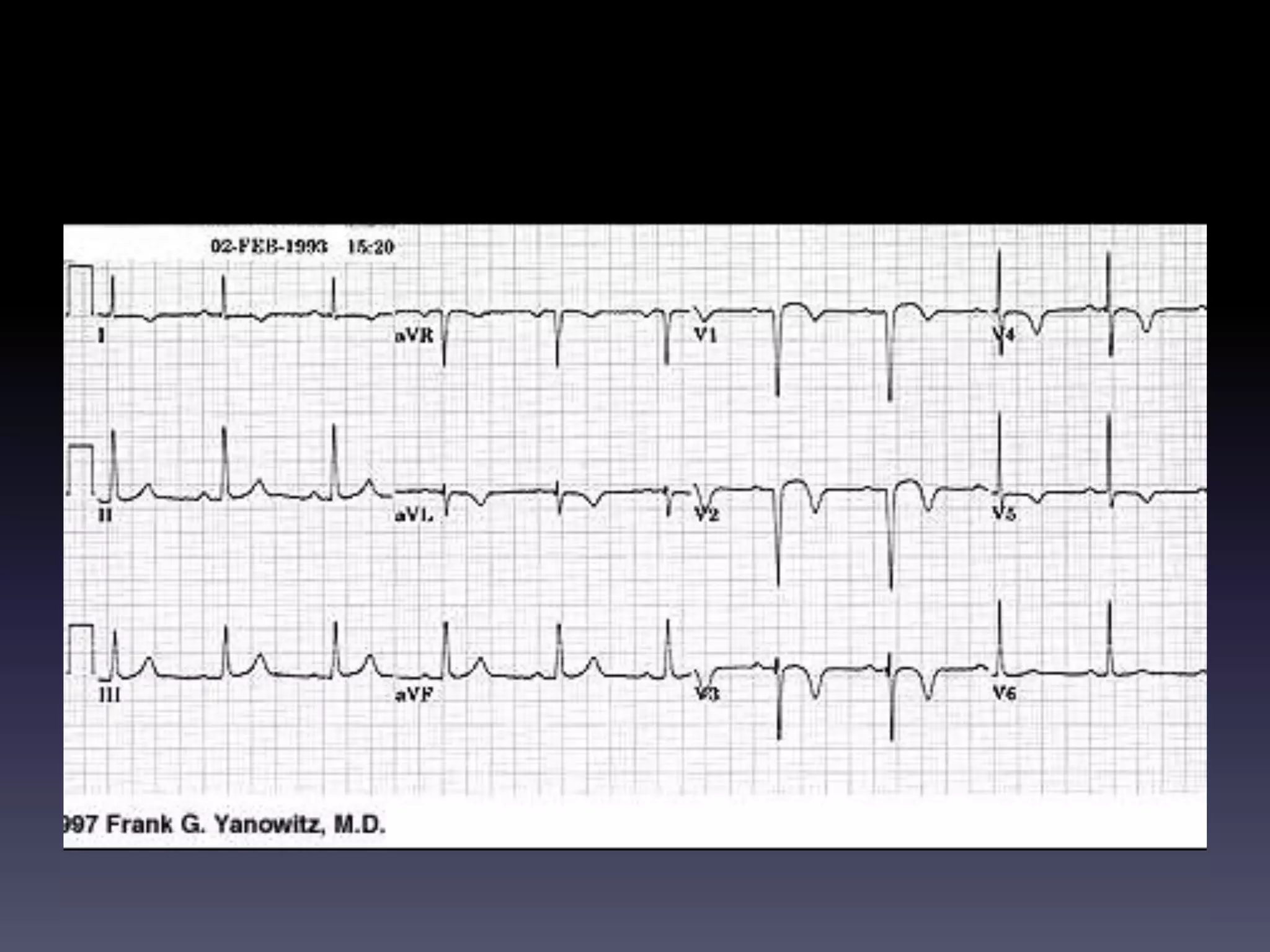 Systematic ECG Interpretation | PPTX