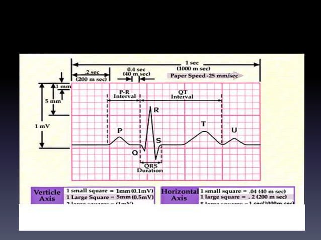 Systematic ECG Interpretation | PPTX | Heart and Cardiovascular ...
