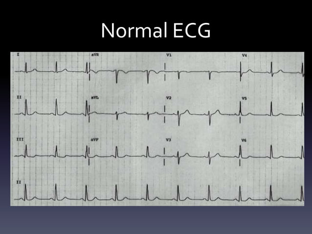 Systematic ECG Interpretation | PPTX | Heart and Cardiovascular ...