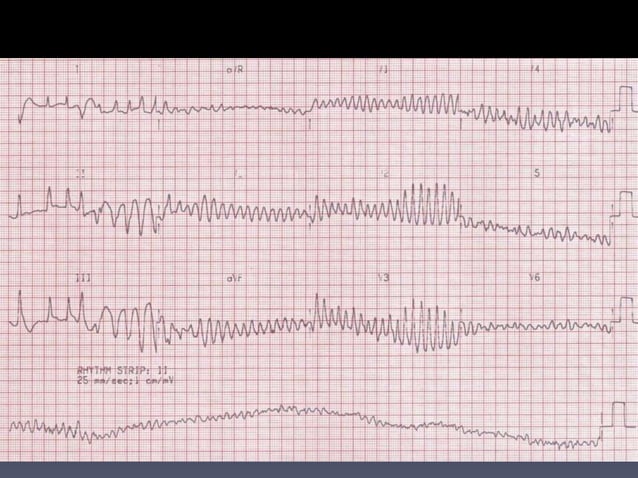 Systematic ECG Interpretation | PPTX | Heart and Cardiovascular ...