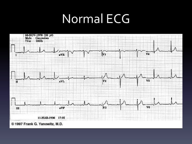 Systematic ECG Interpretation | PPTX | Heart and Cardiovascular ...