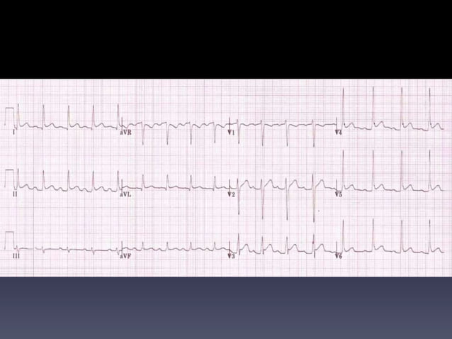 Systematic ECG Interpretation | PPTX | Heart and Cardiovascular ...