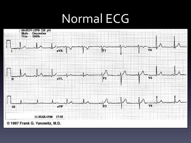 Systematic ECG Interpretation | PPTX | Heart and Cardiovascular ...