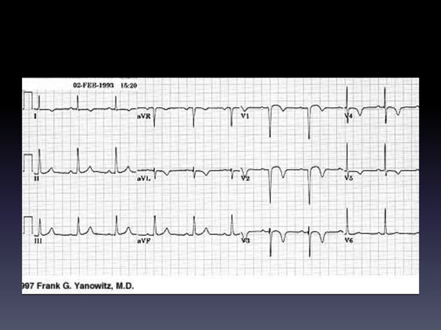 Systematic ECG Interpretation | PPTX | Heart and Cardiovascular ...