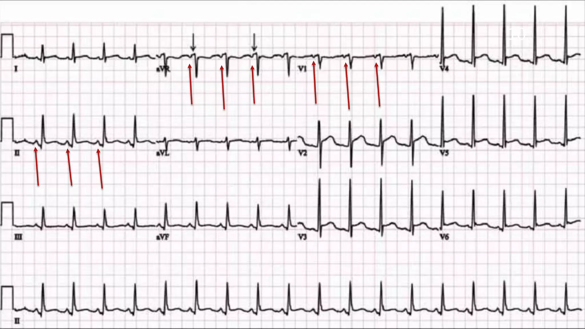 ECG interpretation in emergency settings | PPTX