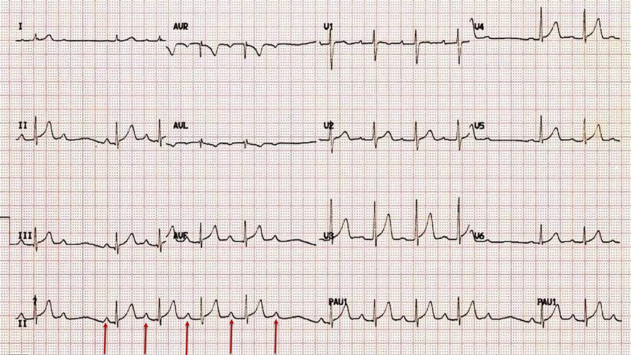 ECG interpretation in emergency settings | PPTX