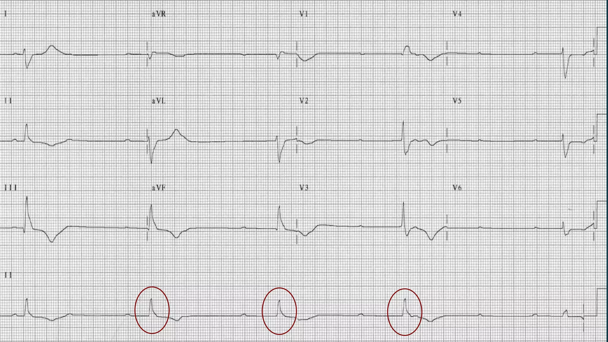 ECG interpretation in emergency settings | PPTX