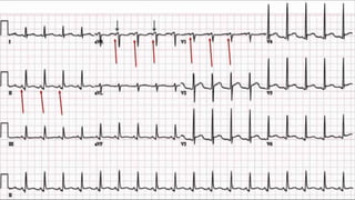 ECG interpretation in emergency settings | PPTX