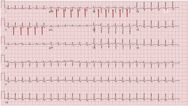 ECG interpretation in emergency settings | PPTX | Heart and ...