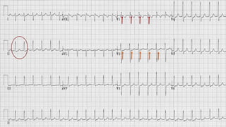 ECG interpretation in emergency settings | PPTX