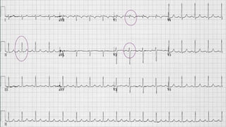 ECG interpretation in emergency settings | PPTX
