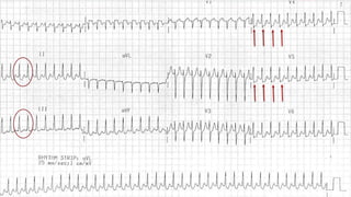 ECG interpretation in emergency settings | PPTX