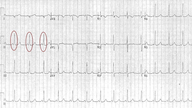 ECG interpretation in emergency settings | PPTX | Heart and ...
