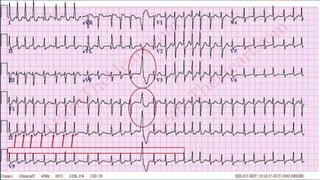 ECG interpretation in emergency settings | PPTX
