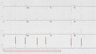 ECG interpretation in emergency settings | PPTX