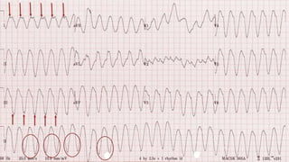 ECG interpretation in emergency settings | PPTX