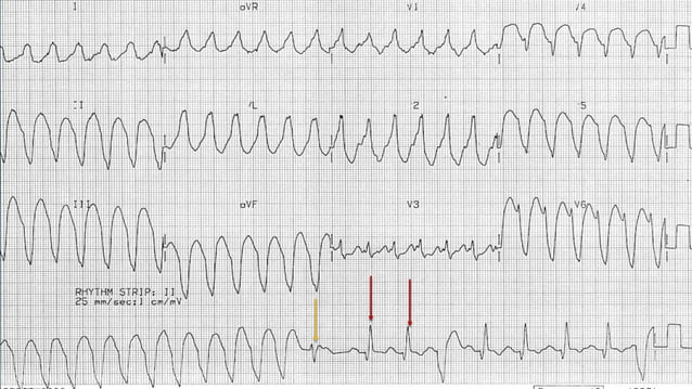 ECG interpretation in emergency settings | PPTX | Heart and ...