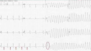 ECG interpretation in emergency settings | PPTX