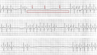ECG interpretation in emergency settings | PPTX