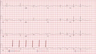 ECG interpretation in emergency settings | PPTX