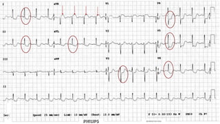 ECG interpretation in emergency settings | PPTX