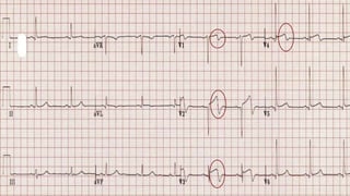 ECG interpretation in emergency settings | PPTX