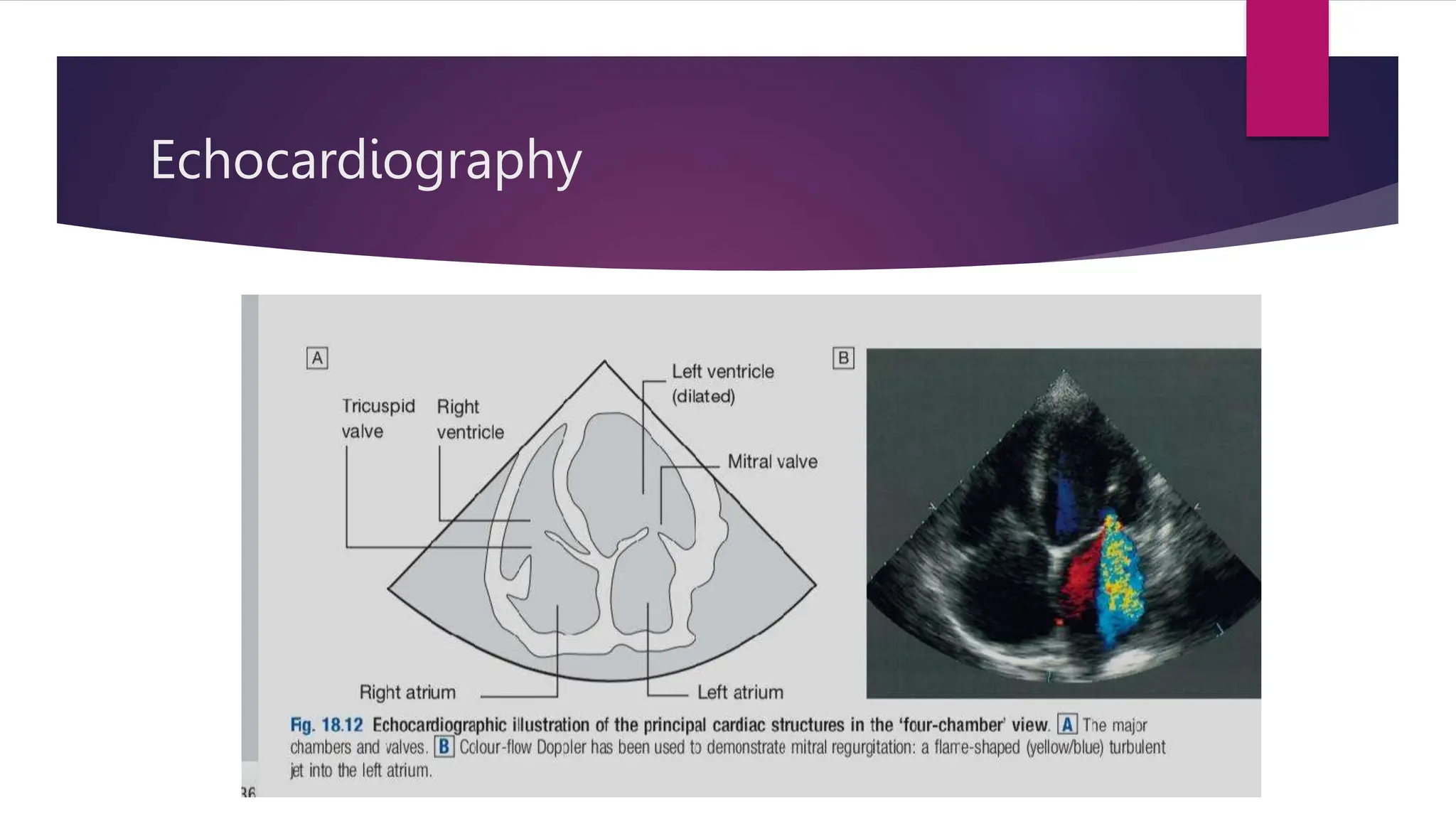 ECG interpretation: Echocardiography and Cardiac Catherization.pptx