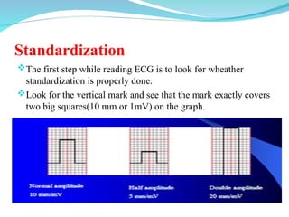 Electrocardiography (ECG)interpretation .ppt