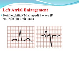 Electrocardiography (ECG)interpretation .ppt