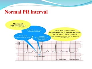 Electrocardiography (ECG)interpretation .ppt