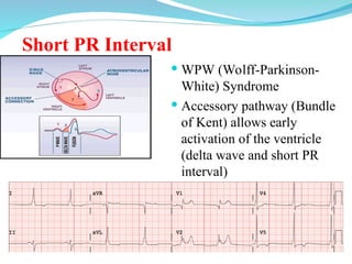 Electrocardiography (ECG)interpretation .ppt