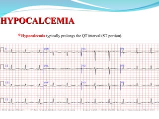 Electrocardiography (ECG)interpretation .ppt