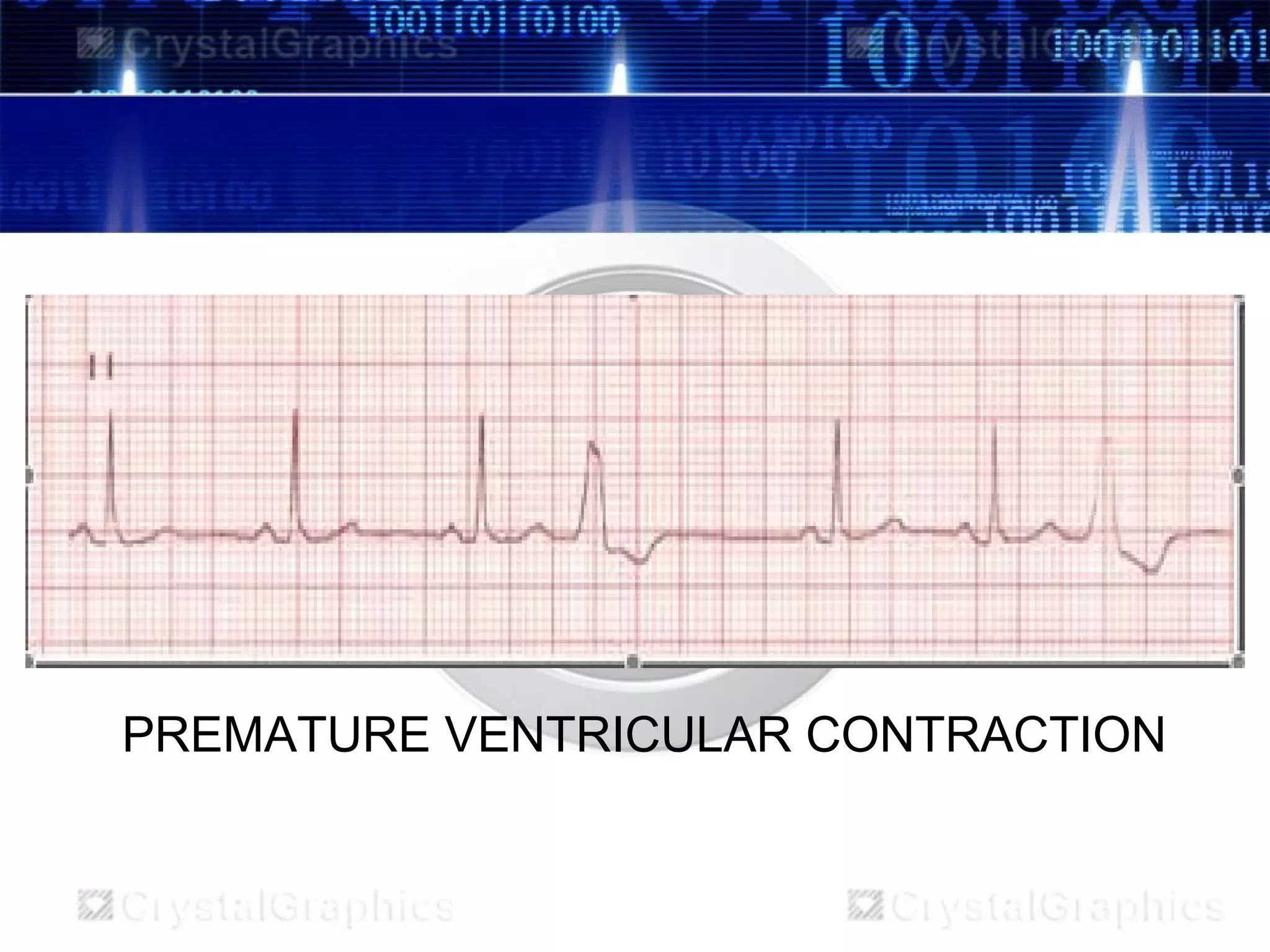 Electrocardiography | PPT