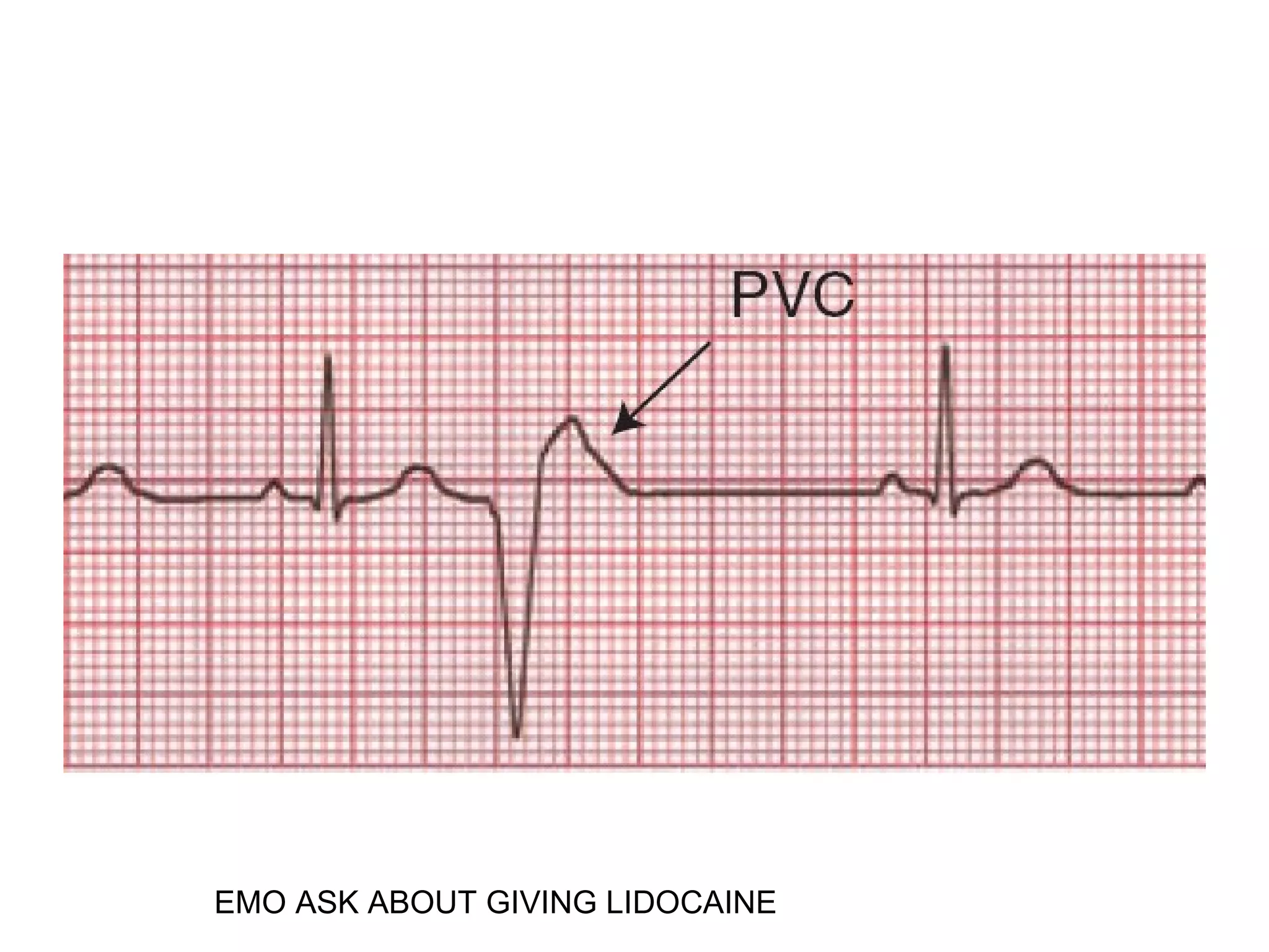Ecg Interpritation (2) | PPT